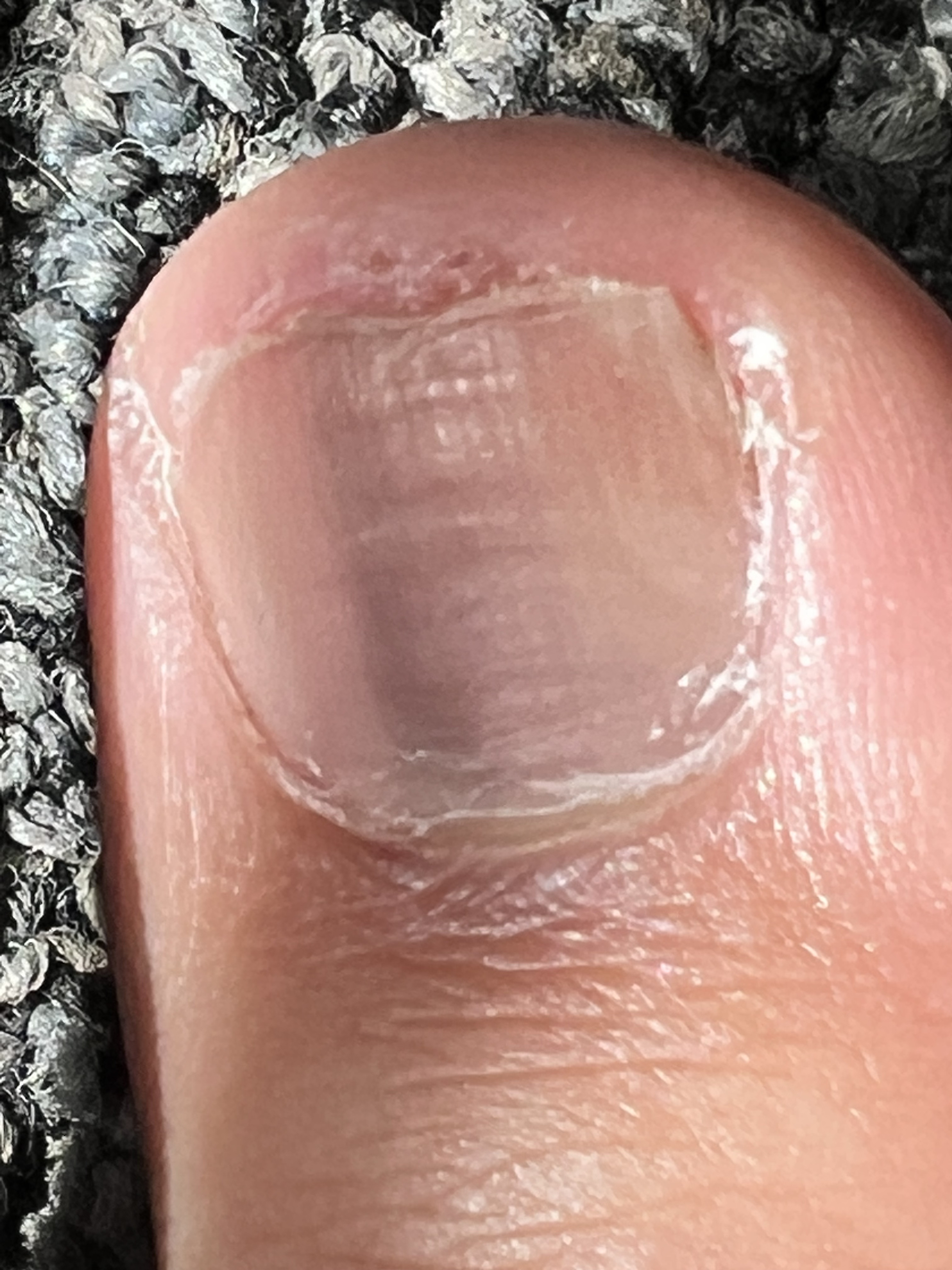 Toenail injuries? (nsfw tag bc of photo link) : r/climbergirls